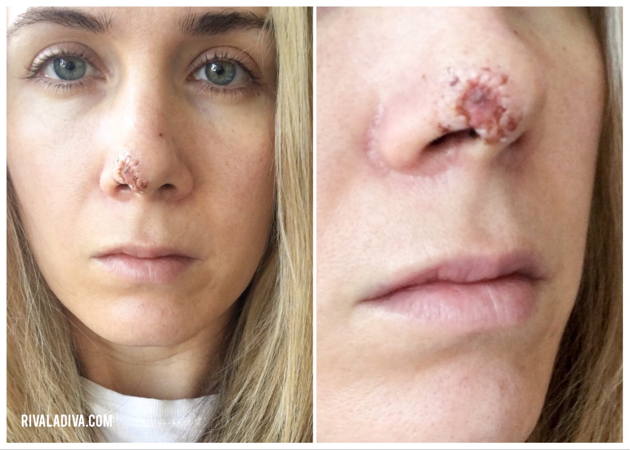 Let's Talk: Skin Cancer - Riva la Diva