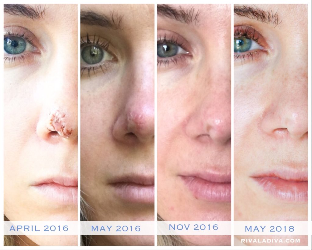 SKIN CANCER: 3 things I wish I knew - Riva la Diva